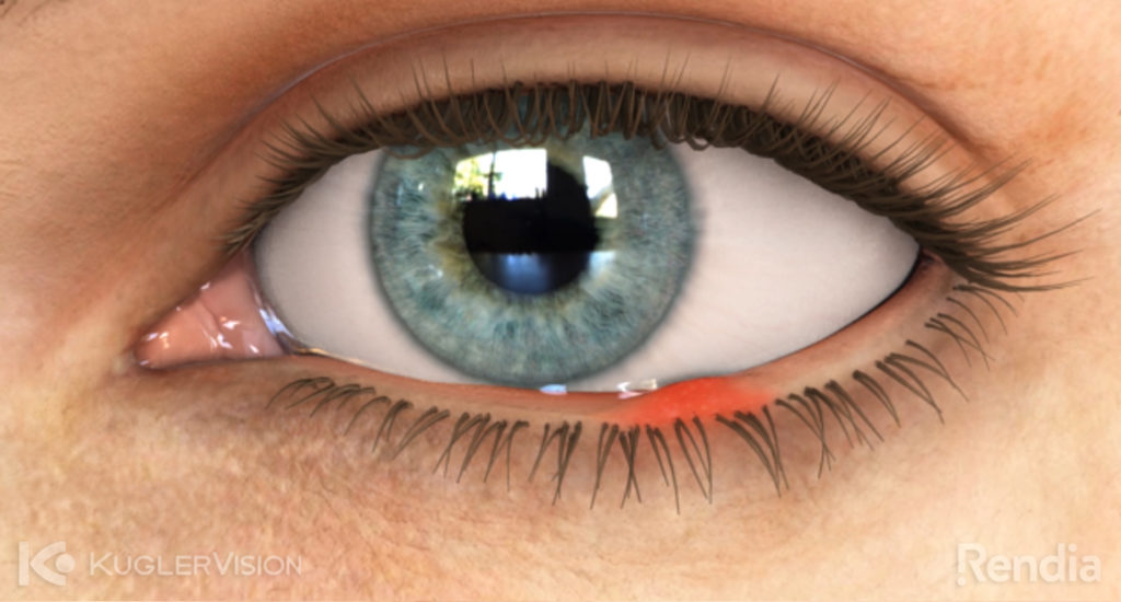 5 Common Eye Conditions - Kugler Vision