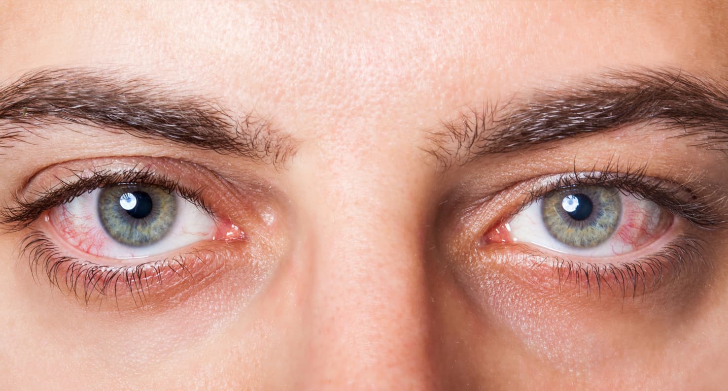 Dry Eye Treatment With BlephEx - Omaha - Kugler Vision