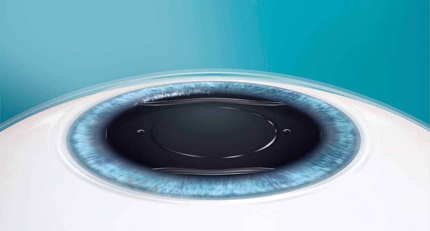 1 Million ICLs Implanted Worldwide – Kugler Vision